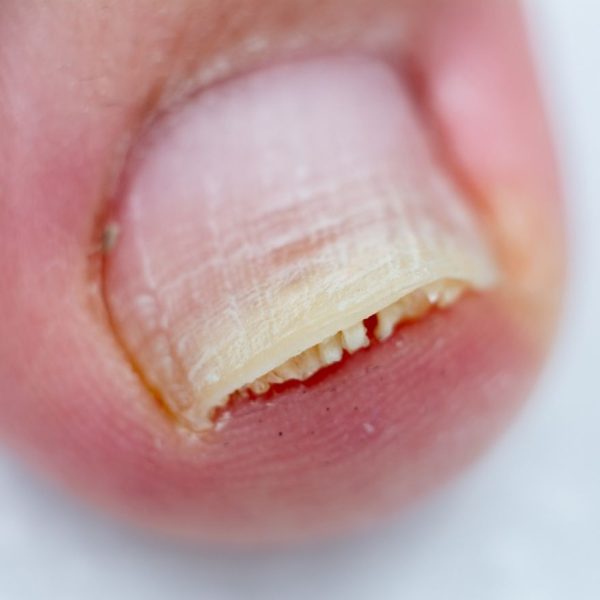 Foundation of Nail Structure - GlossaryLive