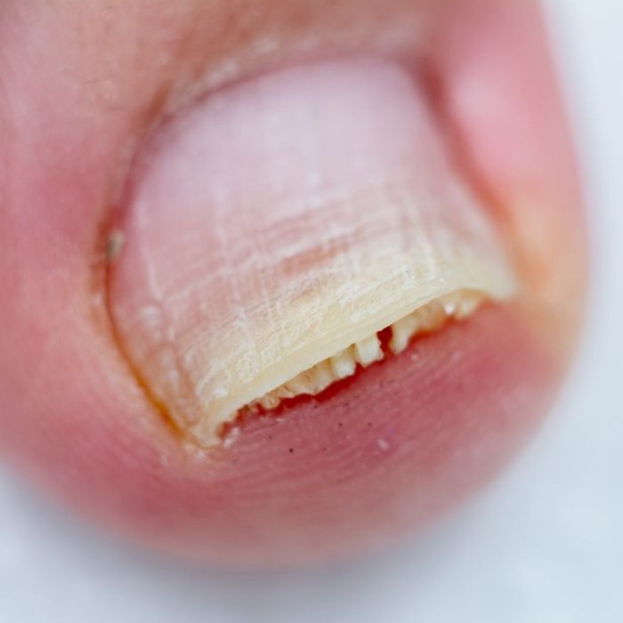 ONYCHOLYSIS - GlossaryLive