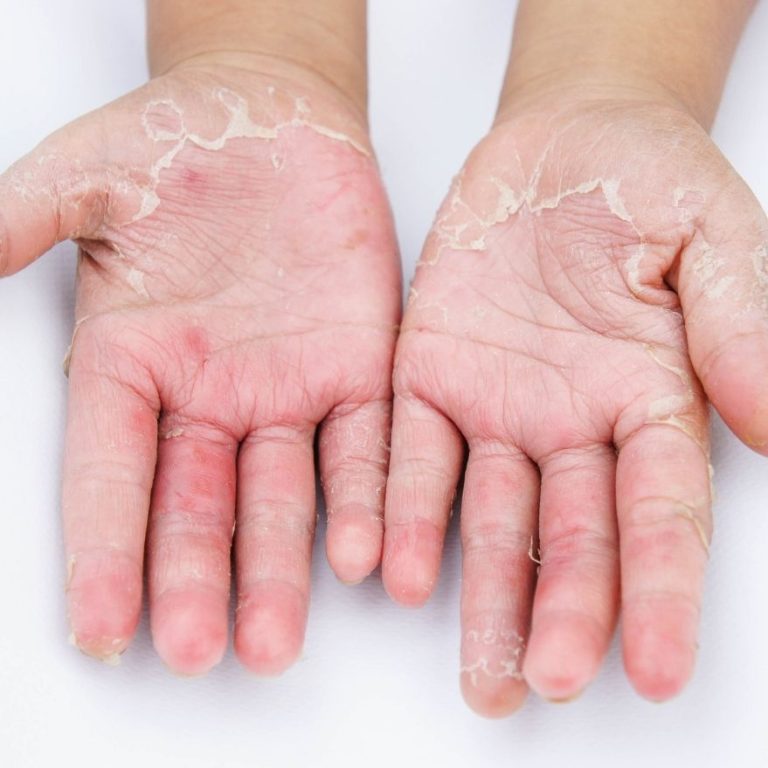 CONTACT DERMATITIS - GlossaryLive